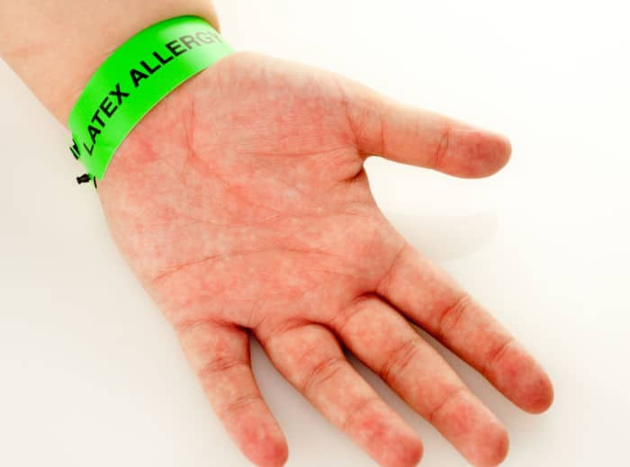 Online Latex Allergy Course Latex Allergy Training Courses For 